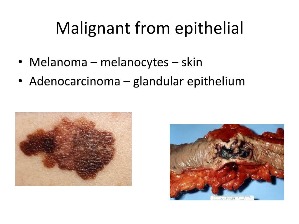 PPT - Tumors and Cancer PowerPoint Presentation, free download - ID:2290231