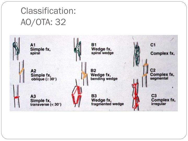 PPT - Femoral Shaft Fracture PowerPoint Presentation - ID:2290727