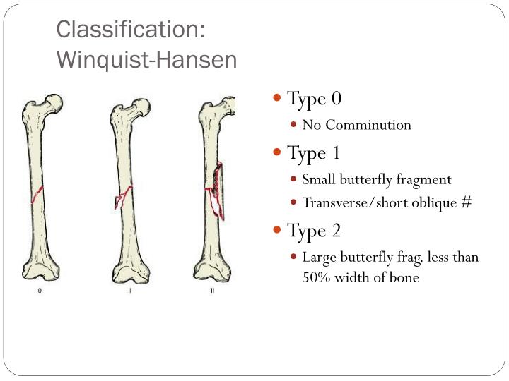 PPT - Femoral Shaft Fracture PowerPoint Presentation - ID:2290727
