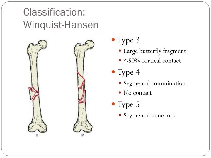 PPT - Femoral Shaft Fracture PowerPoint Presentation - ID:2290727