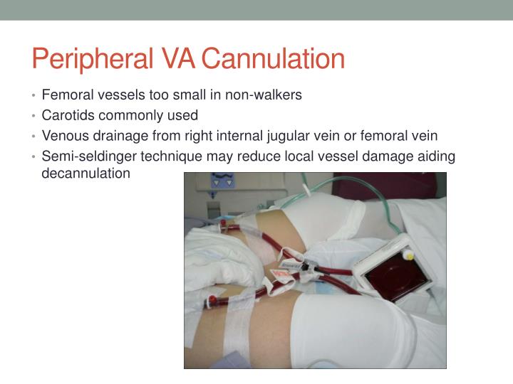 PPT - Cardiac ECMO PowerPoint Presentation - ID:2290904