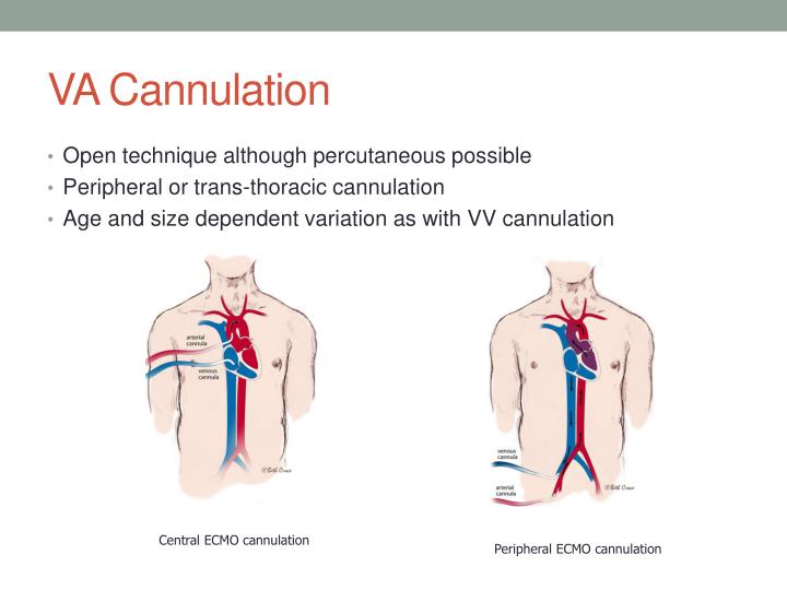 PPT - Cardiac ECMO PowerPoint Presentation - ID:2290904
