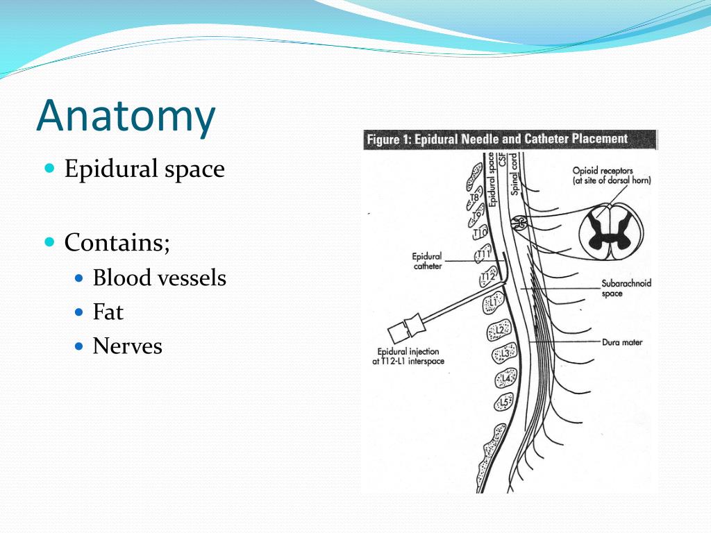 PPT - Acute Pain Management: Epidural Analgesia PowerPoint Presentation ...