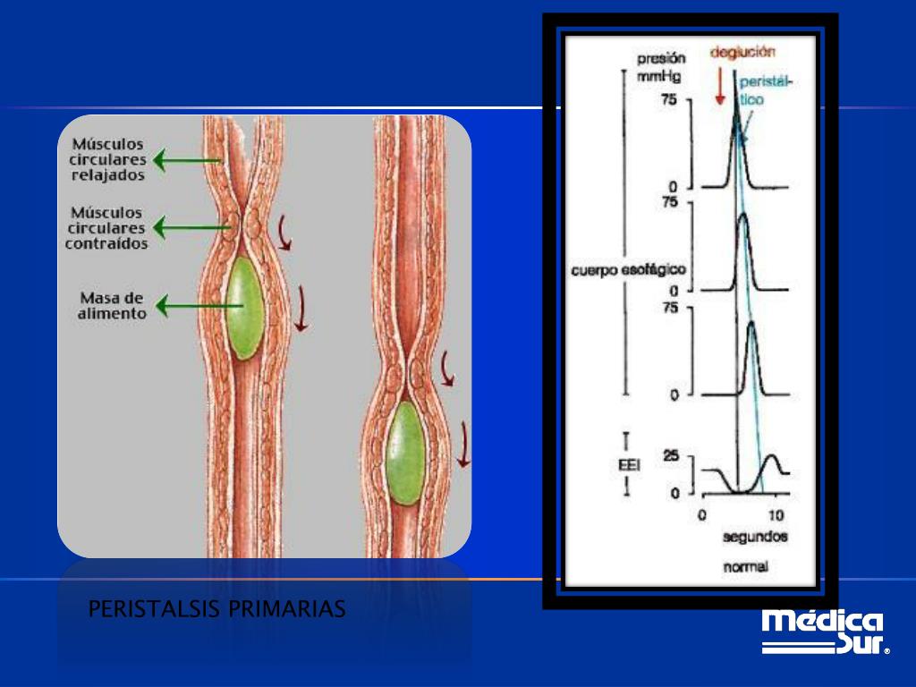 PPT - Trastornos de la motilidad esofágica PowerPoint Presentation ...