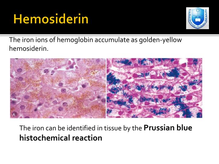 PPT - INTRACELLULAR ACCUMULATIONS and CALCIFICATION PowerPoint ...