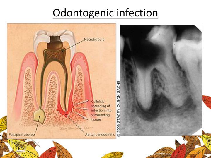 PPT - Odontogenic infection in maxillofacial region PowerPoint ...