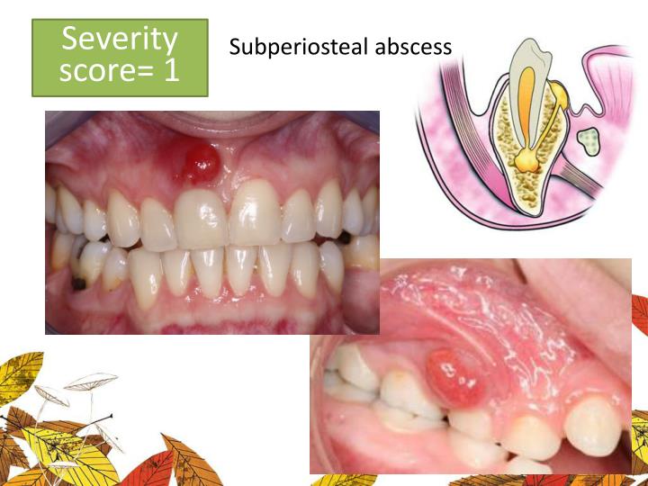 PPT - Odontogenic infection in maxillofacial region PowerPoint ...
