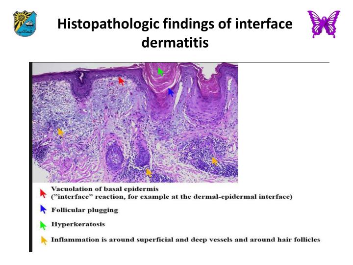PPT - Systemic Lupus Erythematosus Internist Update PowerPoint ...