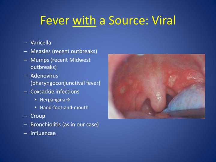 PPT - Pediatric Fever PowerPoint Presentation - ID:2309043