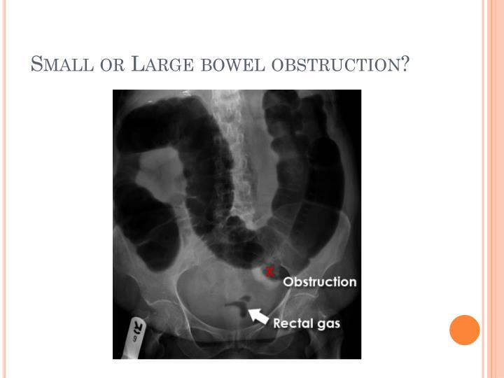 PPT - Bowel Obstruction and Hernias - SLIME teaching 2013 PowerPoint ...