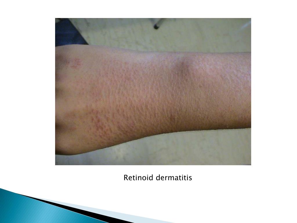 PPT - ADVERSE CUTANEOUS DRUG REACTIONS Course 393 (Prof. Marwan Al ...