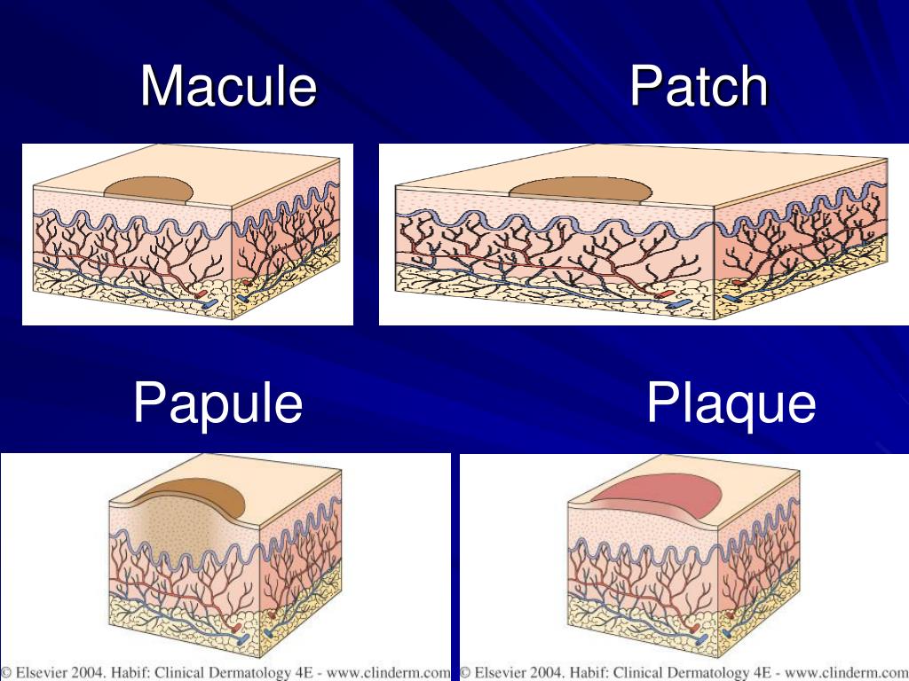 PPT - Dermatologic Manifestations of Chronic Disease PowerPoint ...