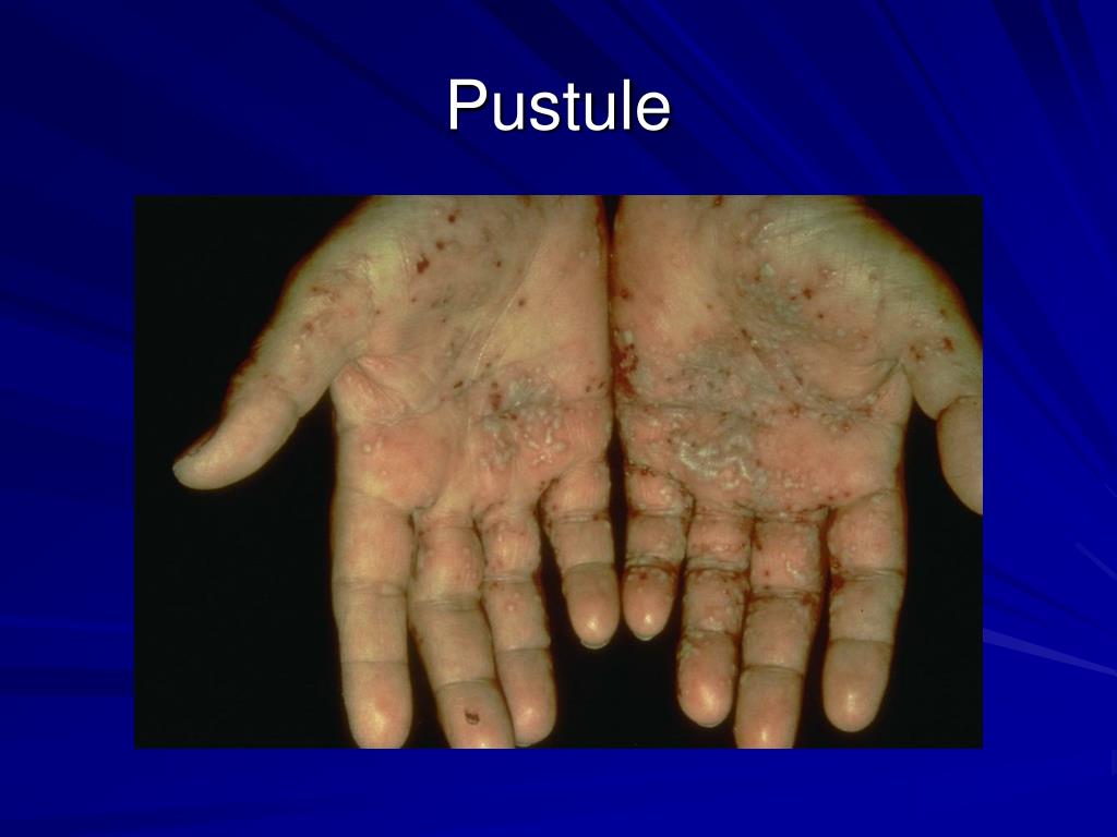 PPT - Dermatologic Manifestations of Chronic Disease PowerPoint ...