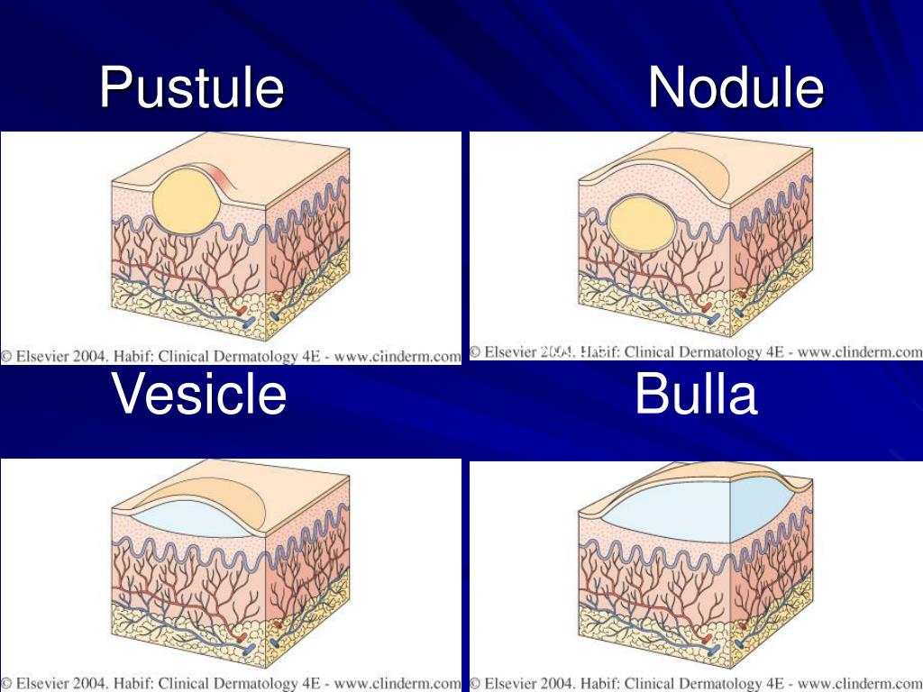 PPT - Dermatologic Manifestations of Chronic Disease PowerPoint ...