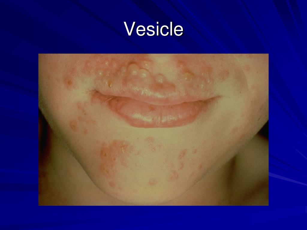 PPT - Dermatologic Manifestations of Chronic Disease PowerPoint ...