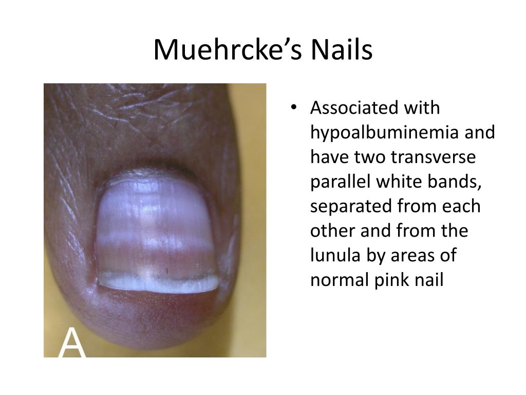 PPT - Cutaneous Manifestations of Renal Disease PowerPoint Presentation ...