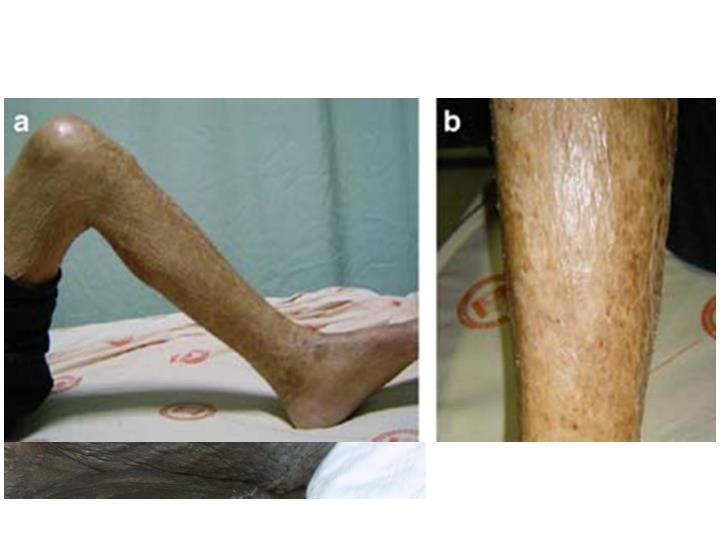 PPT - Cutaneous Manifestations of Renal Disease PowerPoint Presentation ...