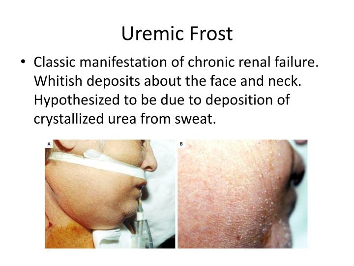 PPT - Cutaneous Manifestations of Renal Disease PowerPoint Presentation ...