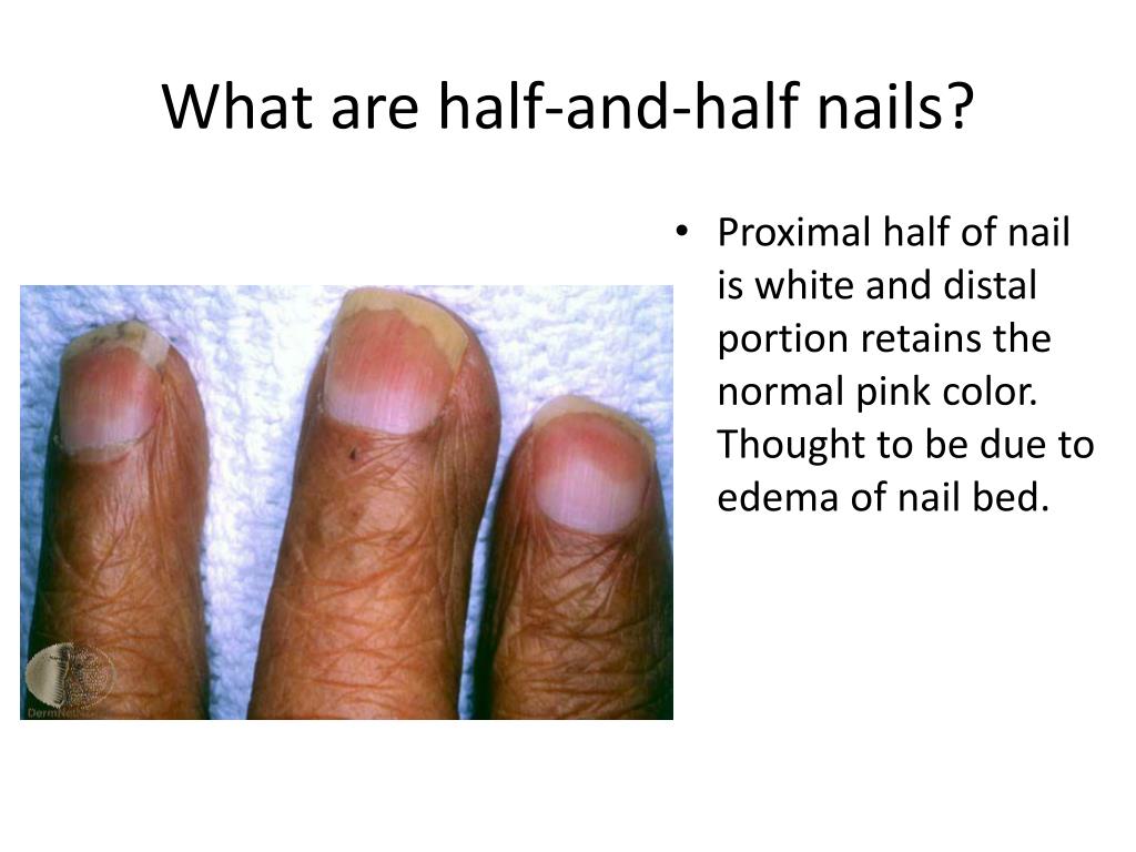 PPT - Cutaneous Manifestations of Renal Disease PowerPoint Presentation ...