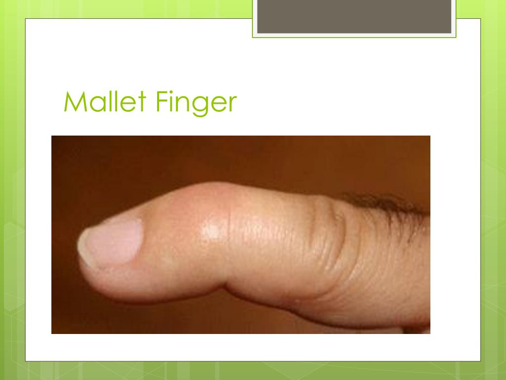 PPT - Pediatric Sports Injuries of the Wrist and Hand PowerPoint ...