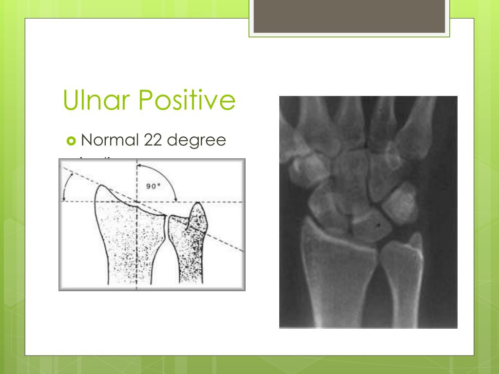 PPT - Pediatric Sports Injuries of the Wrist and Hand PowerPoint ...