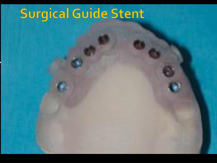 PPT - VIRTUAL IMPLANT SURGERY PowerPoint Presentation - ID:2318604