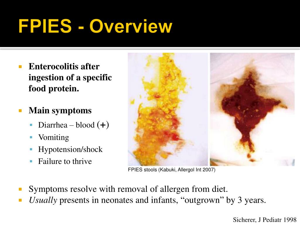 PPT - Food Protein Induced Enterocolitis Sydrome (FPIES) PowerPoint ...