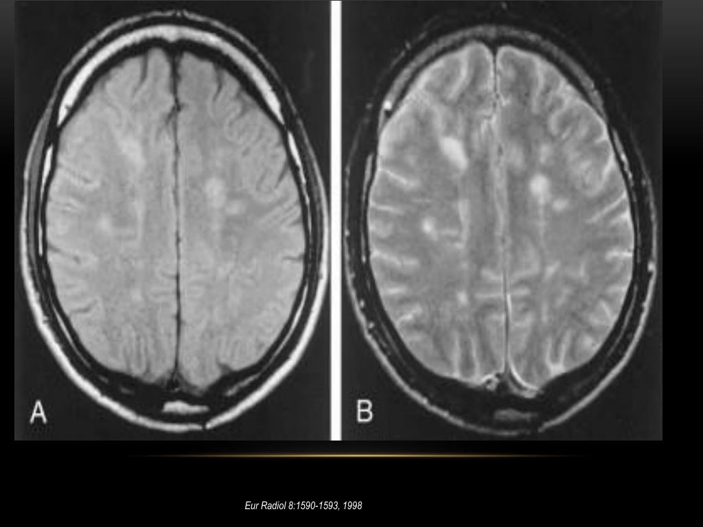 PPT - Síndrome de Embolia grasa liliana paola correa fellow i medicina ...