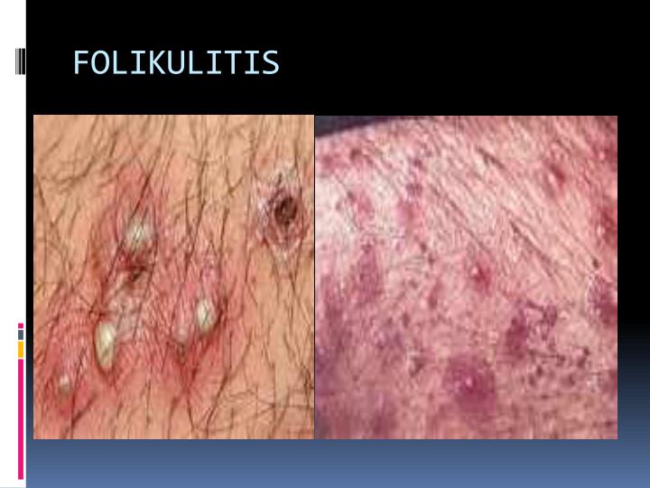 PPT - GANGGUAN SISTEM INTEGUMEN PowerPoint Presentation - ID:2324044