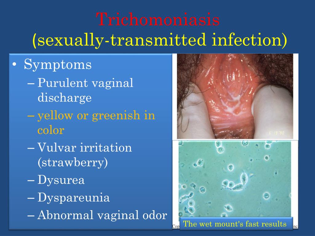 PPT - Candida infection T ricpmonas vaginalis Bacterial vaginosis ...