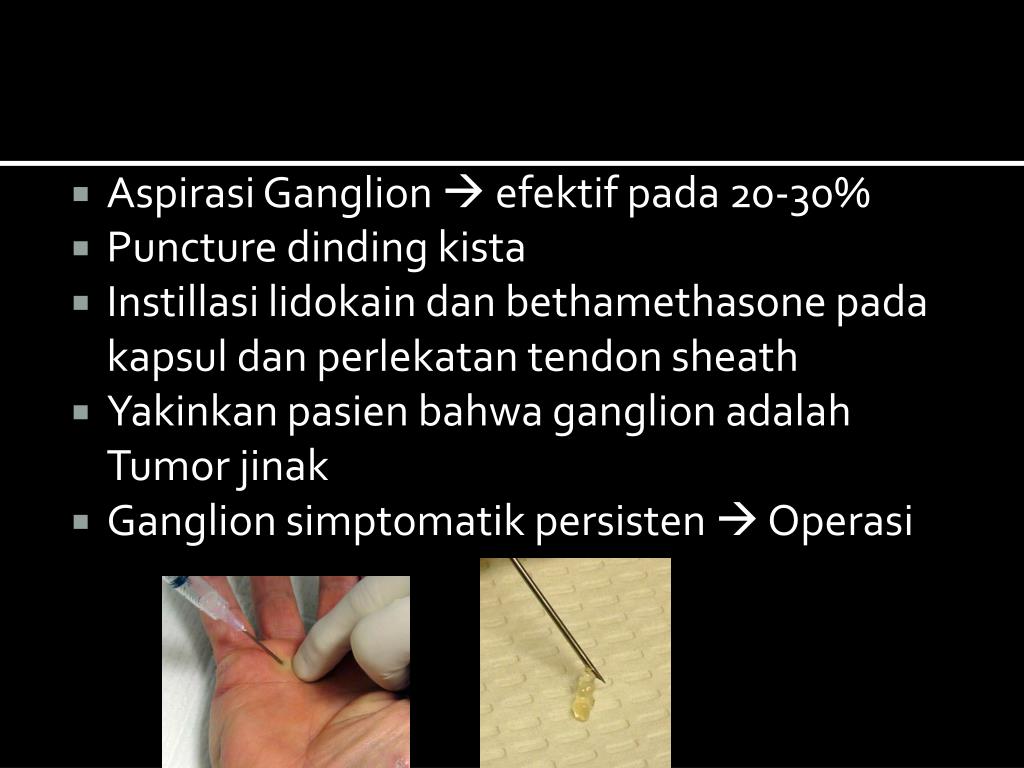 PPT - GANGLION PADA PERGELANGAN TANGAN & TANGAN PowerPoint Presentation ...