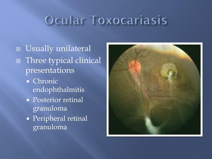 PPT - ATYPICAL PRESENTATIONs OF Ocular toxocariasis PowerPoint ...