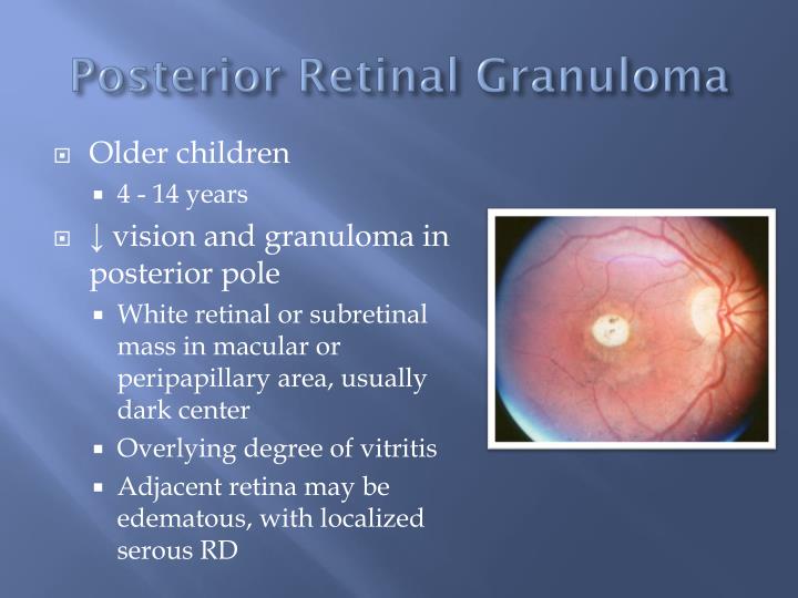 PPT - ATYPICAL PRESENTATIONs OF Ocular toxocariasis PowerPoint ...