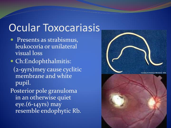 PPT - White Pupillary reflex in children PowerPoint Presentation - ID ...