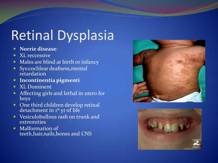 PPT - White Pupillary reflex in children PowerPoint Presentation - ID ...