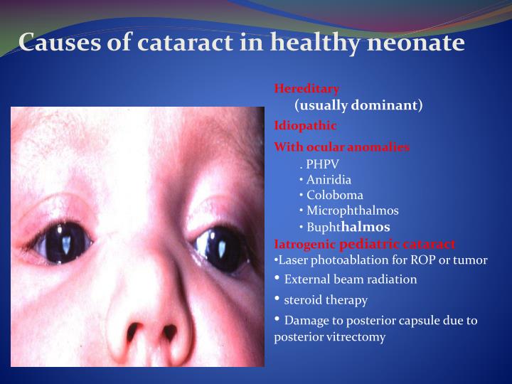 PPT - White Pupillary reflex in children PowerPoint Presentation - ID ...