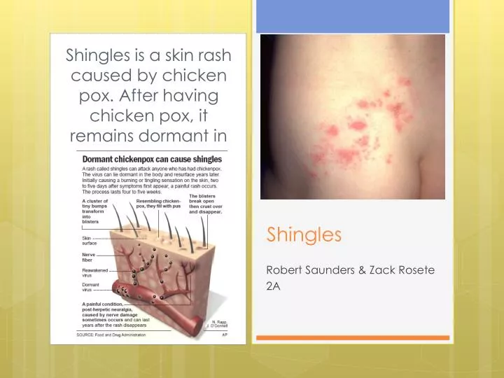 PPT - Shingles PowerPoint Presentation, free download - ID:2335107