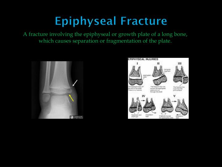 PPT - Fracture Types PowerPoint Presentation - ID:2339788