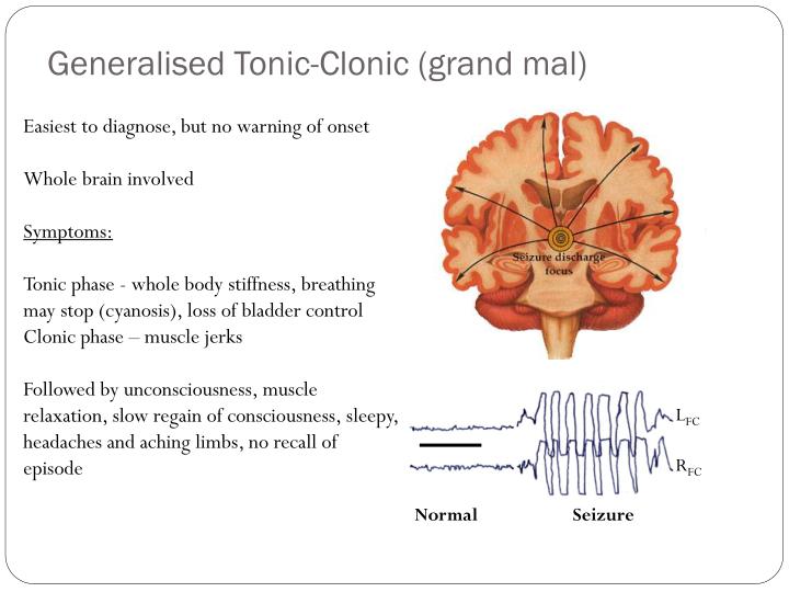 PPT - Epilepsy PowerPoint Presentation - ID:2341272