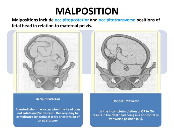 PPT - Malpresentation Malposition PowerPoint Presentation - ID:2343401