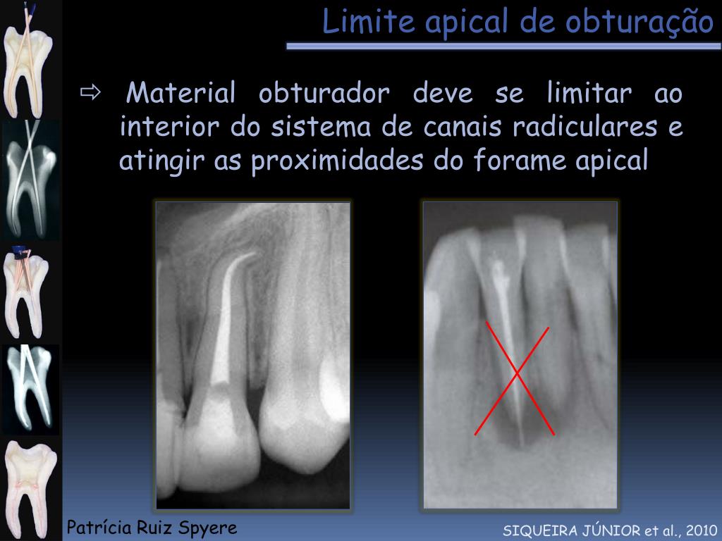 PPT - Obturação do Sistema de Canais Radiculares PowerPoint ...