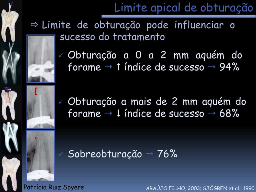 PPT - Obturação do Sistema de Canais Radiculares PowerPoint ...