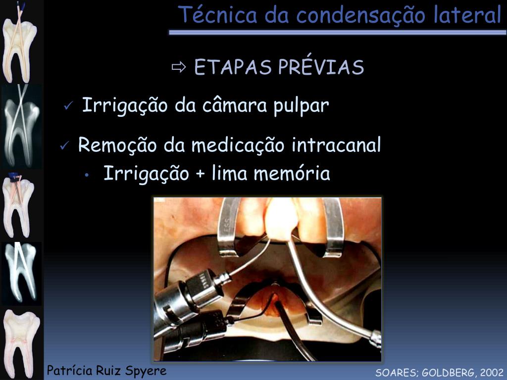 PPT - Obturação do Sistema de Canais Radiculares PowerPoint ...