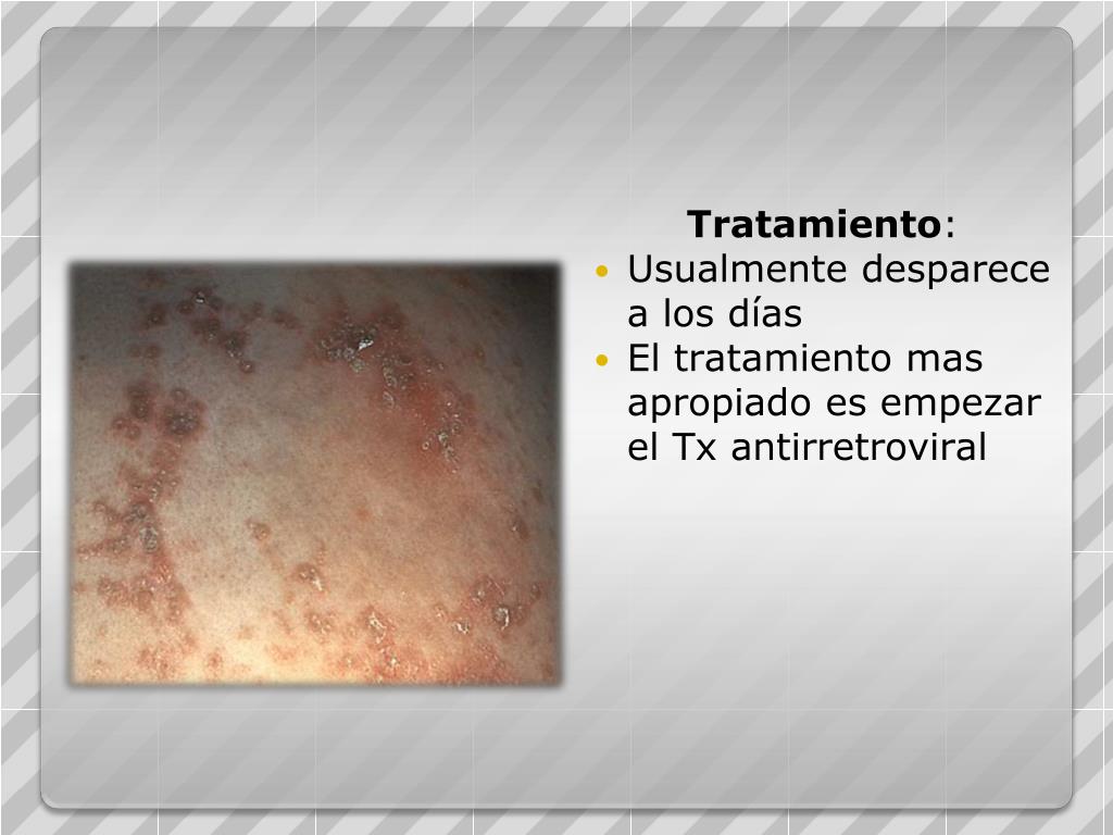 PPT - Manifestaciones cutáneas en el SIDA PowerPoint Presentation, free ...
