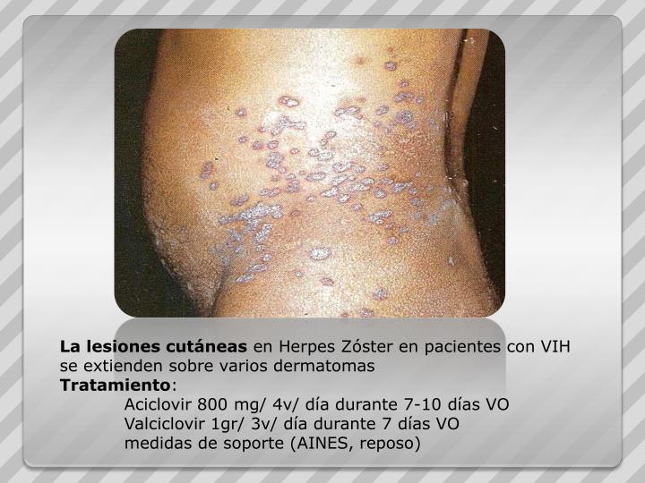 PPT - Manifestaciones cutáneas en el SIDA PowerPoint Presentation - ID ...