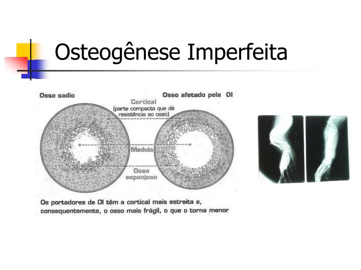 PPT - Osteogênese Imperfeita PowerPoint Presentation - ID:2347227
