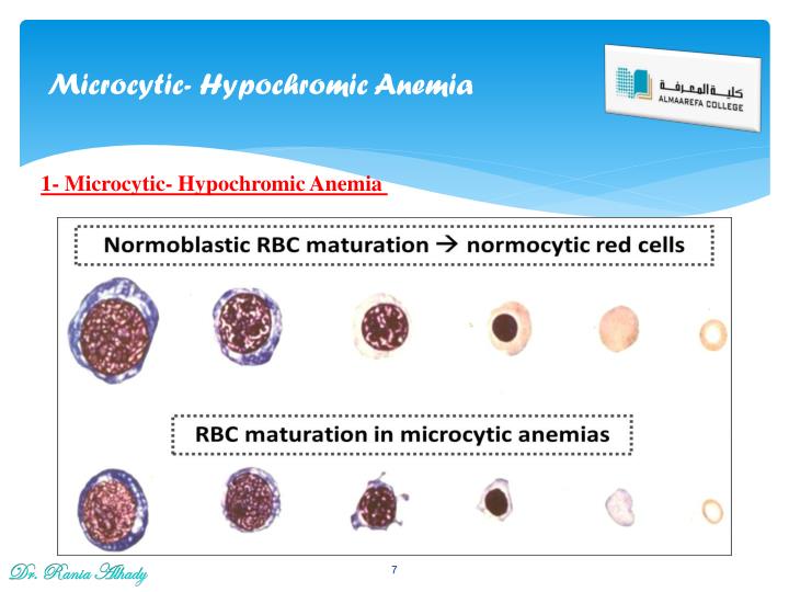 PPT - Laboratory diagnosis of Anemia PowerPoint Presentation - ID:2347811