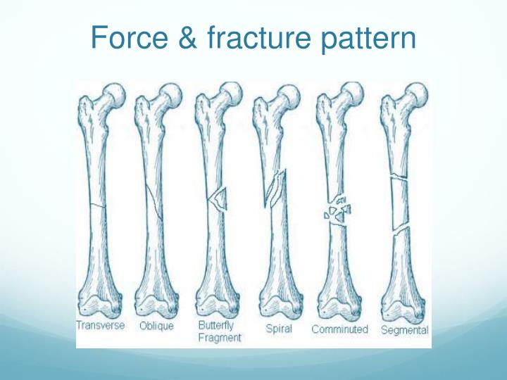PPT - Principles of Fractures & Fracture Management PowerPoint ... PPT - Principles of Fractures & Fracture Management PowerPoint ...