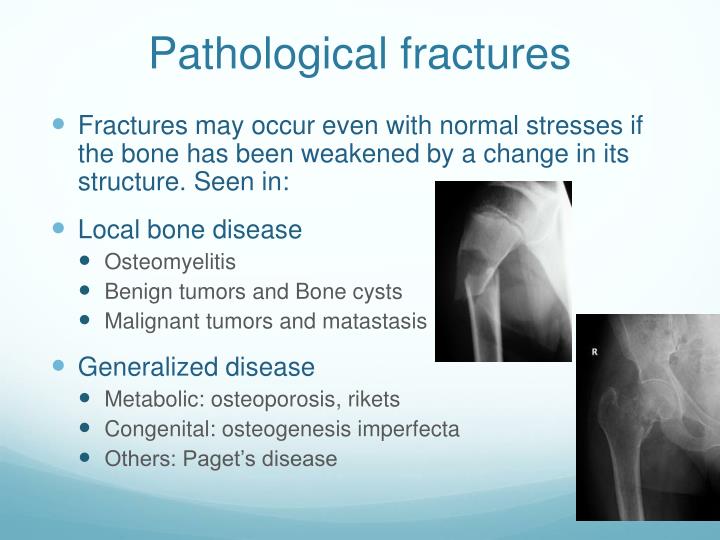 PPT - Principles of Fractures & Fracture Management PowerPoint ...