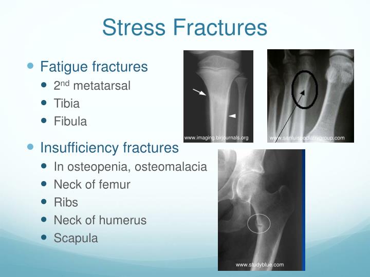 PPT - Principles of Fractures & Fracture Management PowerPoint ...